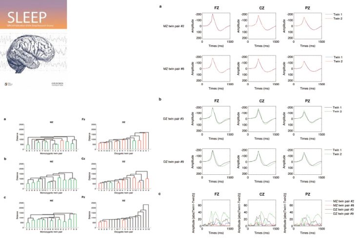 The heritability of the human K-complex: a twin study - Sonnomed